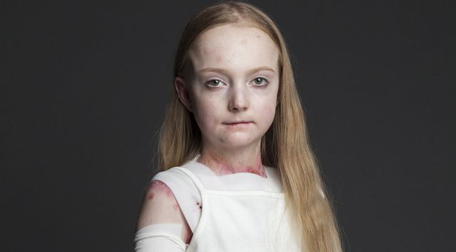 WATCH: 'Butterfly disease' sufferer Claudia (14) speaks with idol ...