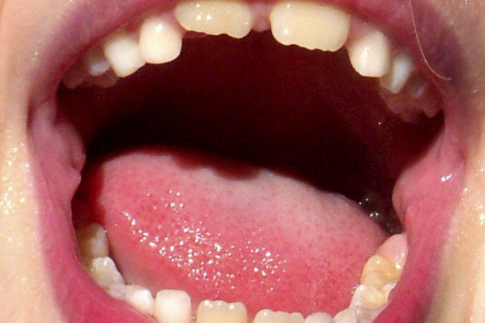 'Soft adult teeth' can be a severe dental problem | Irish Independent