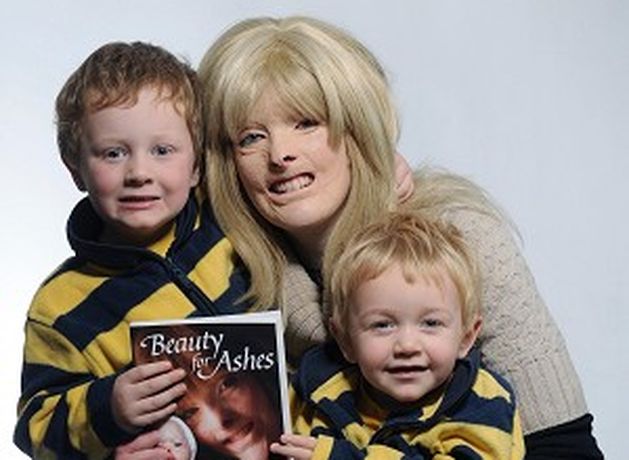 Burns woman tells story in book | Irish Independent