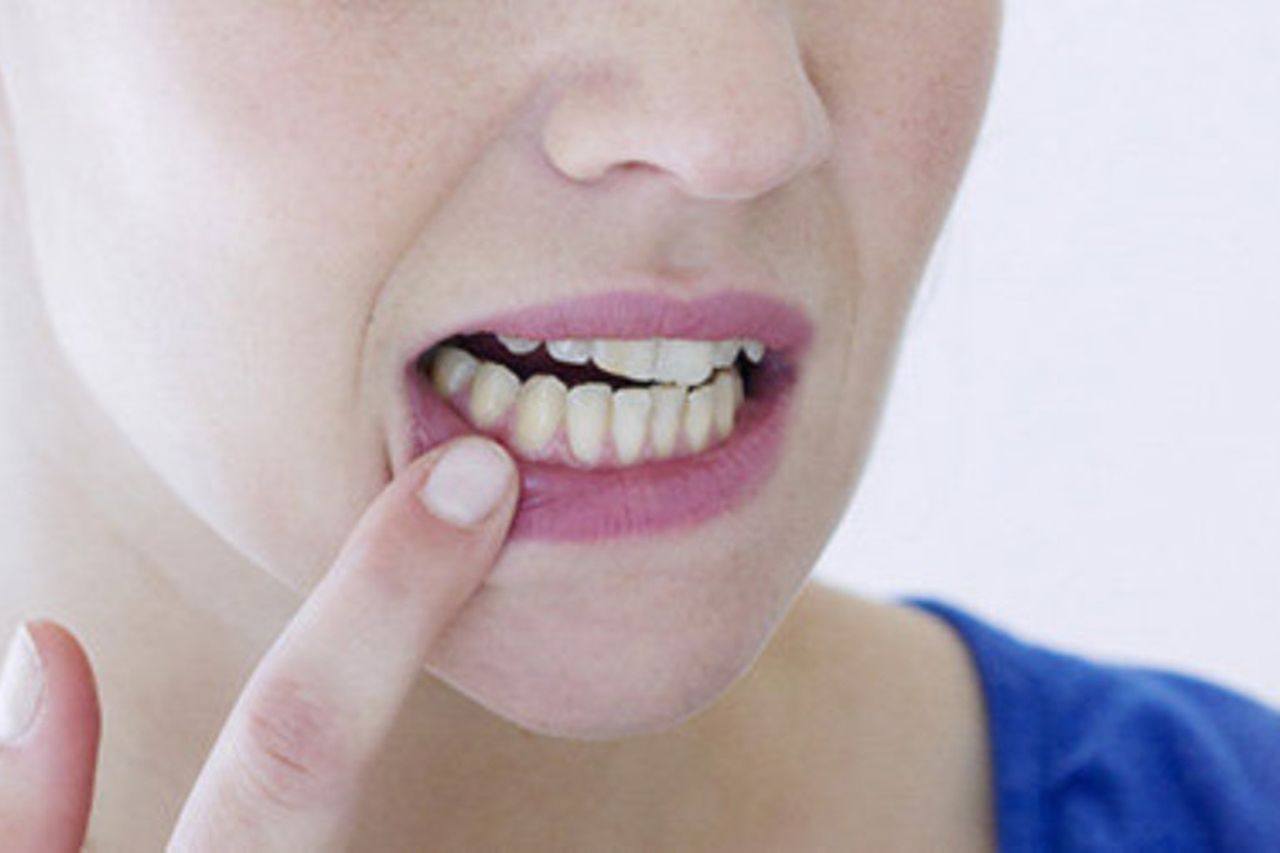 Natural solutions to help prevent mouth ulcers | Independent.ie