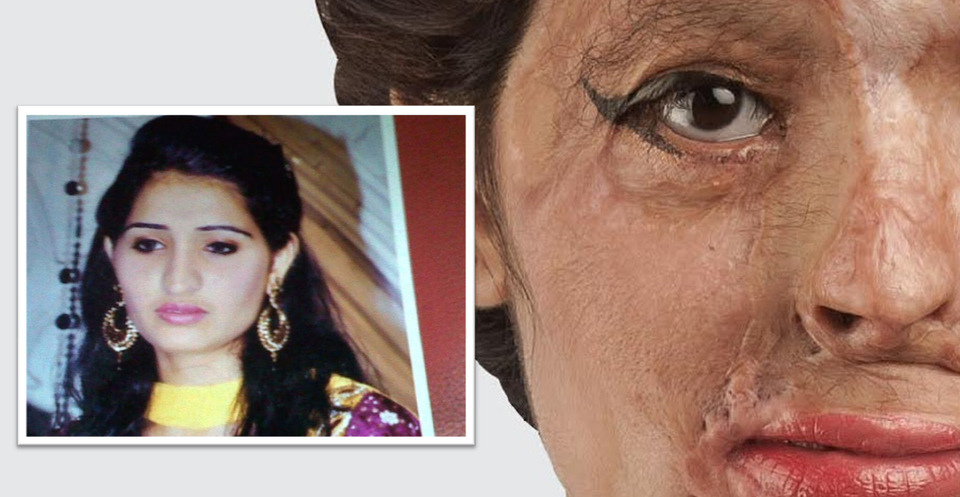 Acid Attack Victims Before And After
