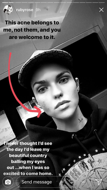 Ruby Rose shares make-up free image as she tells fans: This acne ...