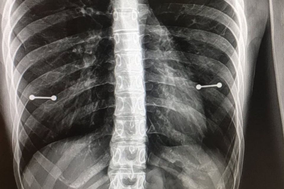 Mum discovers daughter’s nipple piercings after X-ray reveals more than ...
