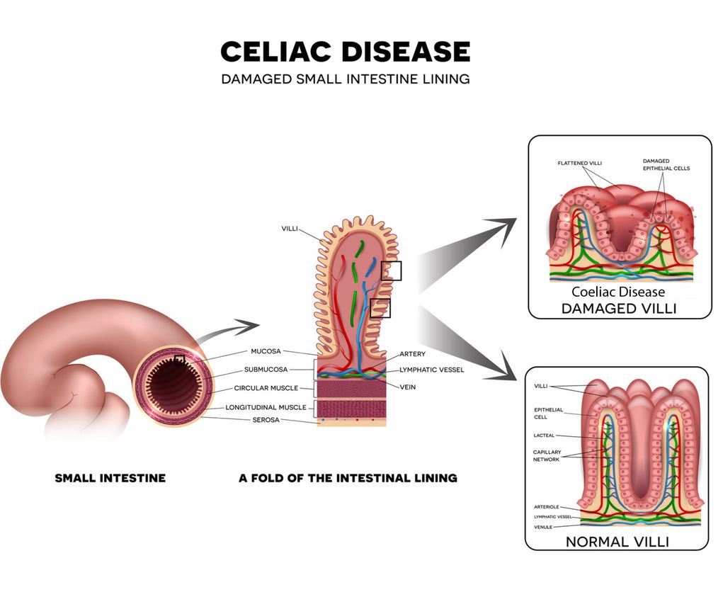Irish dietitian Orla Walsh: What exactly is coeliac disease? | Irish ...