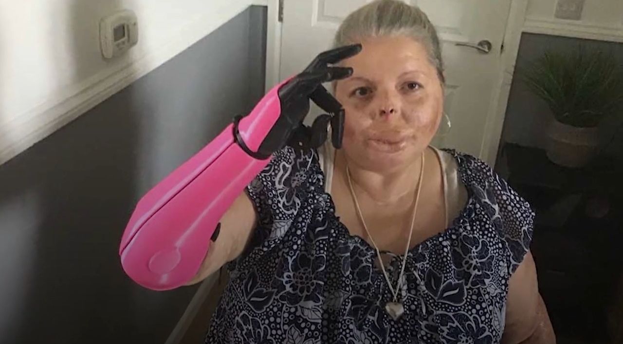 Inspiring Mum Who Lost Four Limbs To Sepsis Receives First Bionic Hero