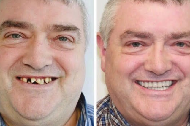 'My teeth frightened the dentist' - Irish man (55) 'feels like a new ...