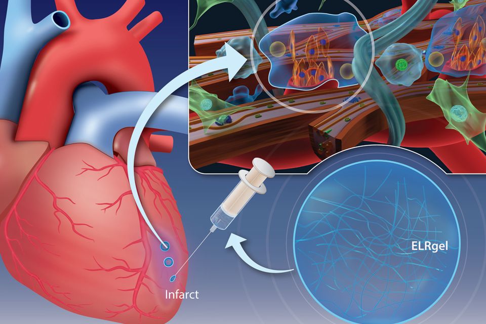 Gel injection may change the way heart muscle heals after heart attack ...